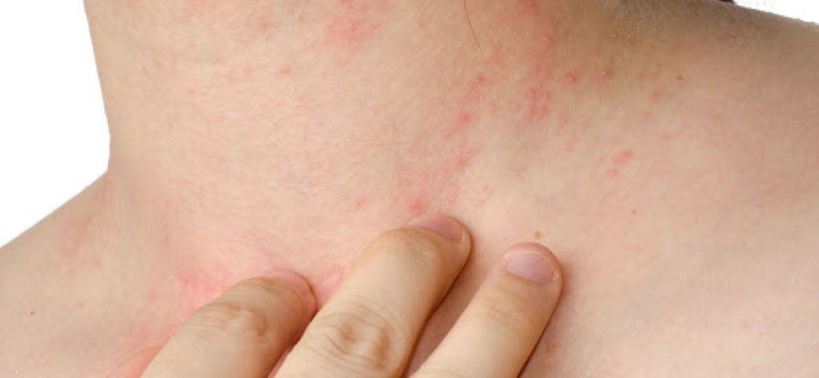 O que é brotoeja? | Dra Izabella Rached - Dermatologista, alergologista ...