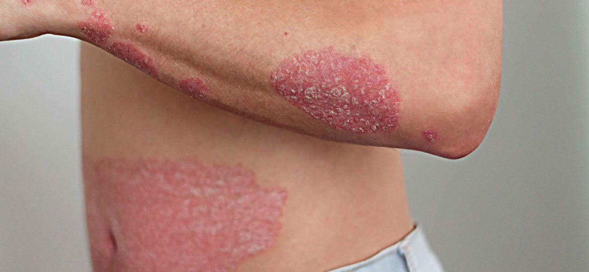 O que é Psoríase | Dra Izabella Rached - Dermatologista, alergologista ...